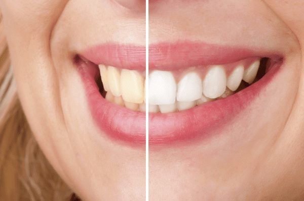 How Can I Fix My Discolored Teeth? | Arlington Heights IL Dentist