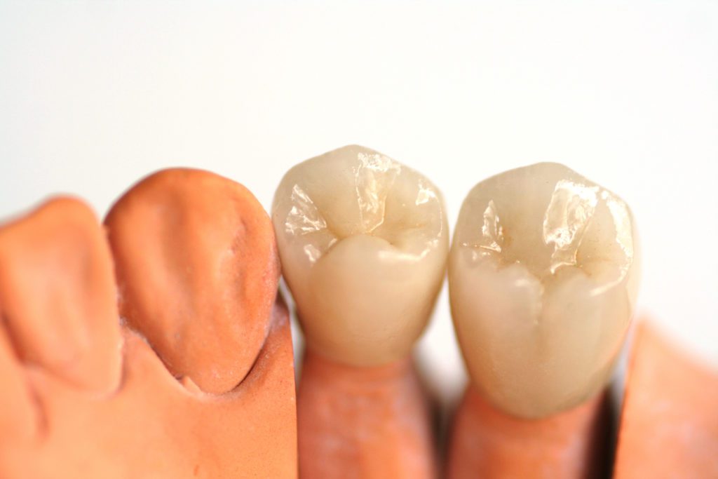 Do You Need Crowns or Partial Crowns? | Arlington Heights IL