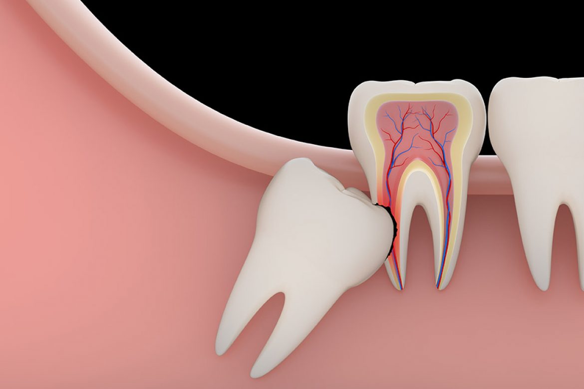 What Should I Know About Wisdom Teeth? | AH Smiles